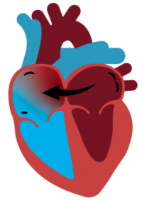 Treatment for HFpEF/HFmrEF - Corvia® Atrial Shunt